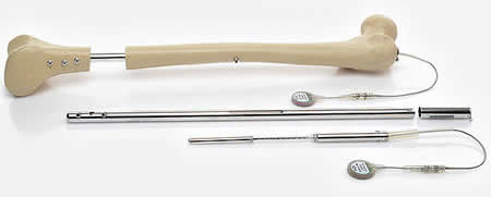 Strawberry Medical - Pectus Carinatum - Pigeon chest wall deformity ...